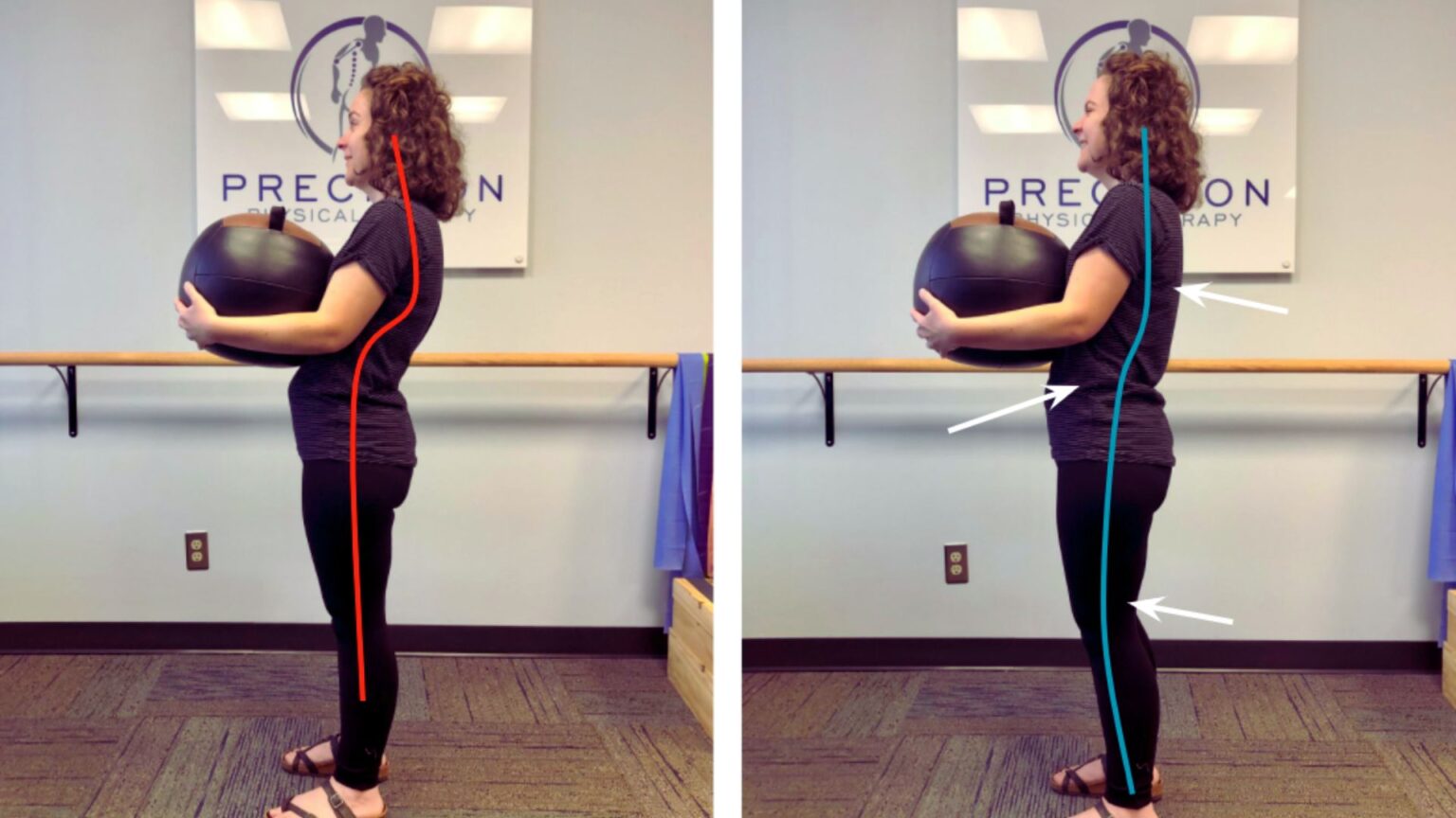Sway Back Posture: Causes, and How to Fix It - XcelerateGyms